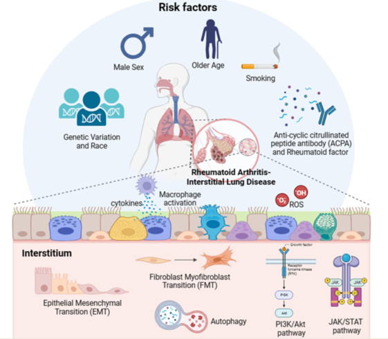 Etiology and Pathogenesis of Rheumatoid Arthritis-Interstitial Lung Disease[v1] | Preprints.org