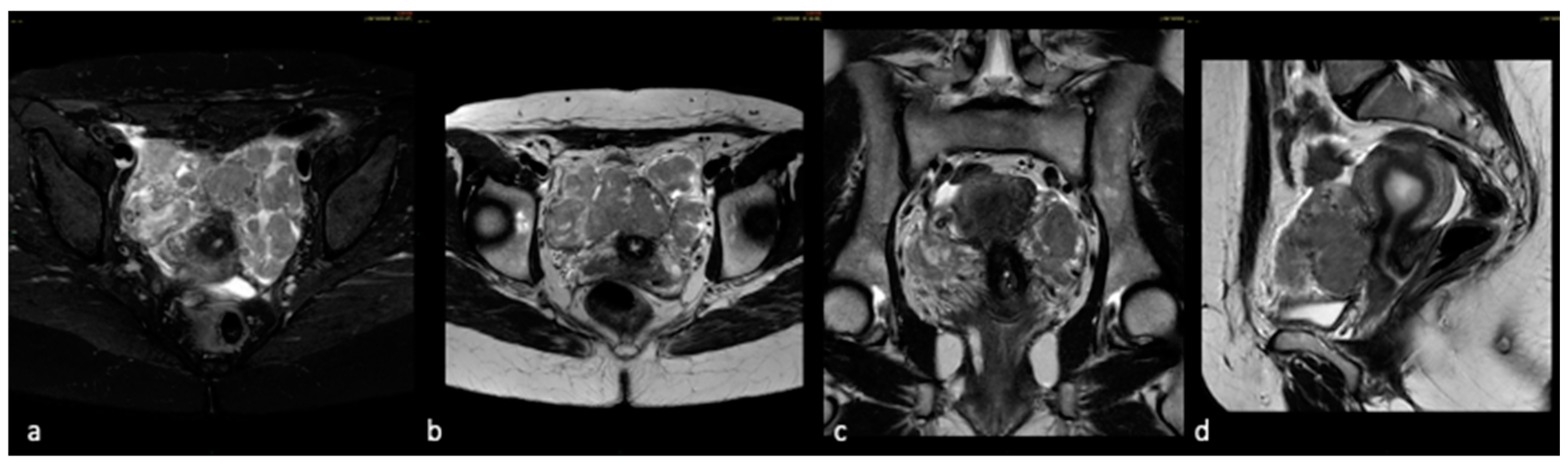 Benign Metastasizing Leiomyomas (BML) an Imaging and Histological ...