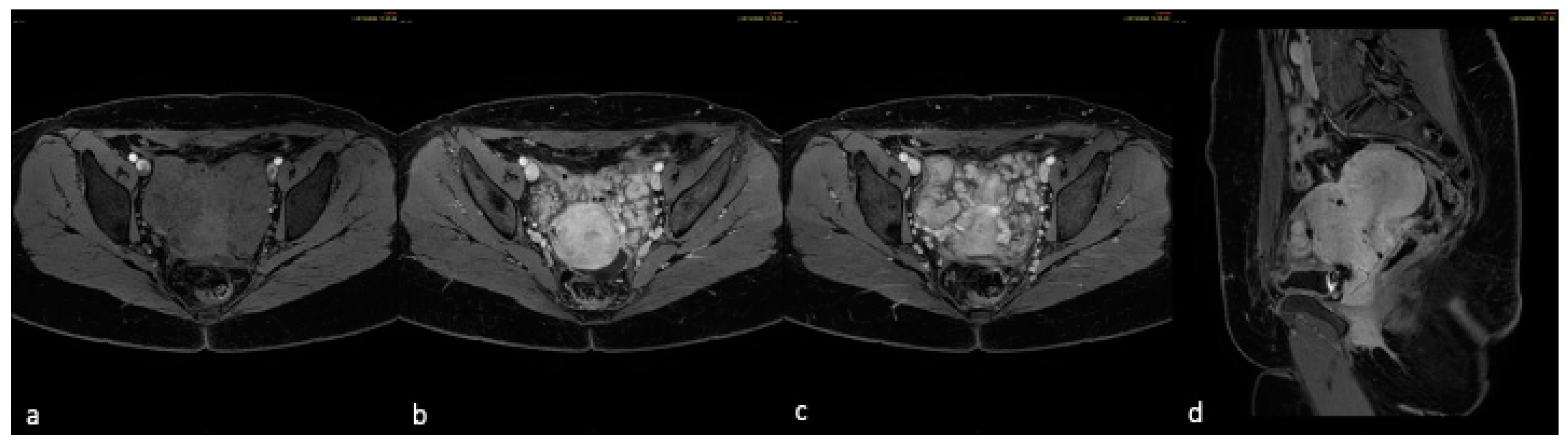 Benign Metastasizing Leiomyomas (BML) an Imaging and Histological ...