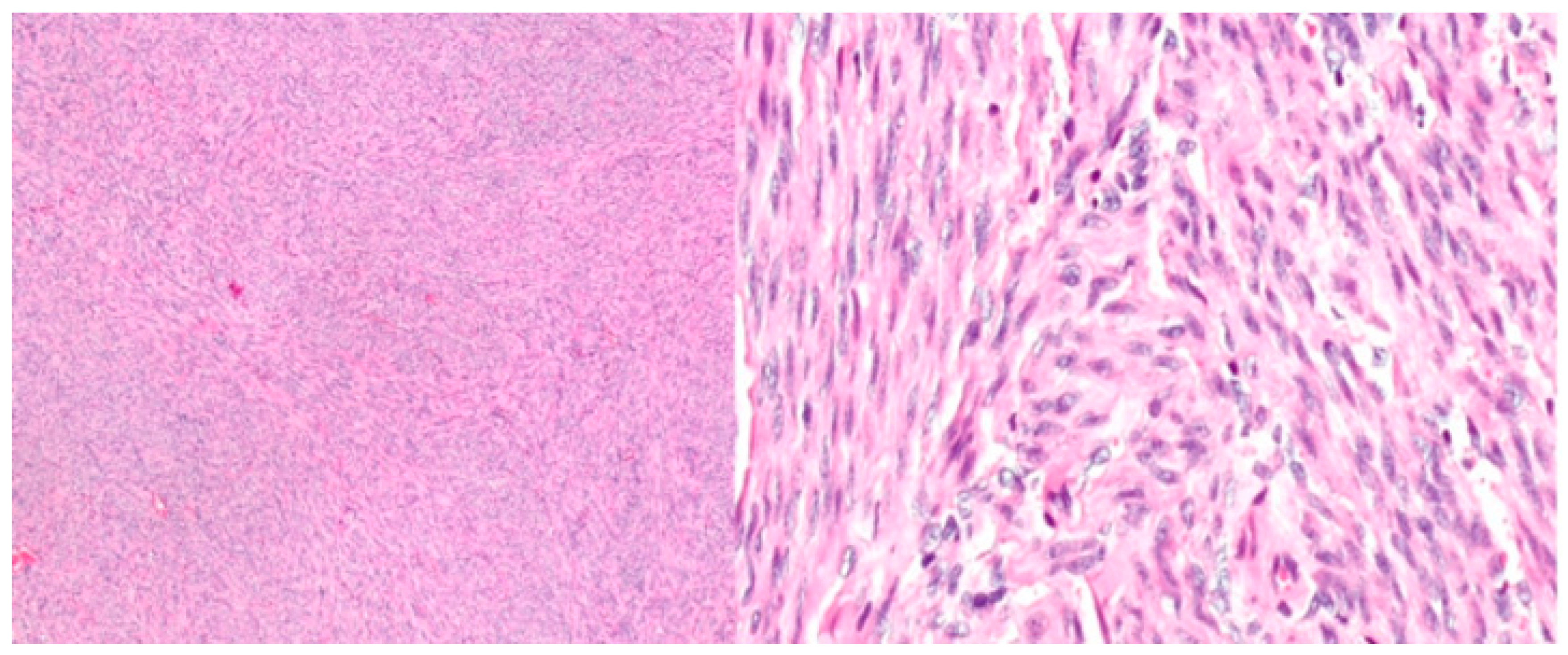 Benign Metastasizing Leiomyomas (BML) an Imaging and Histological ...