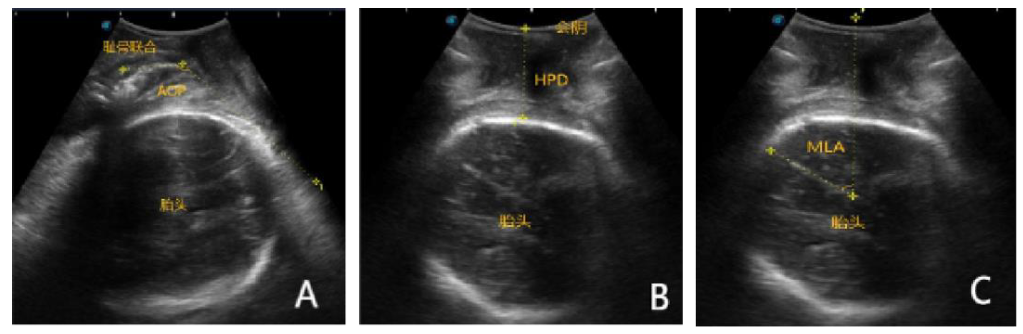 Intrapartum Transperineal Ultrasound Parameters as Predictive ...