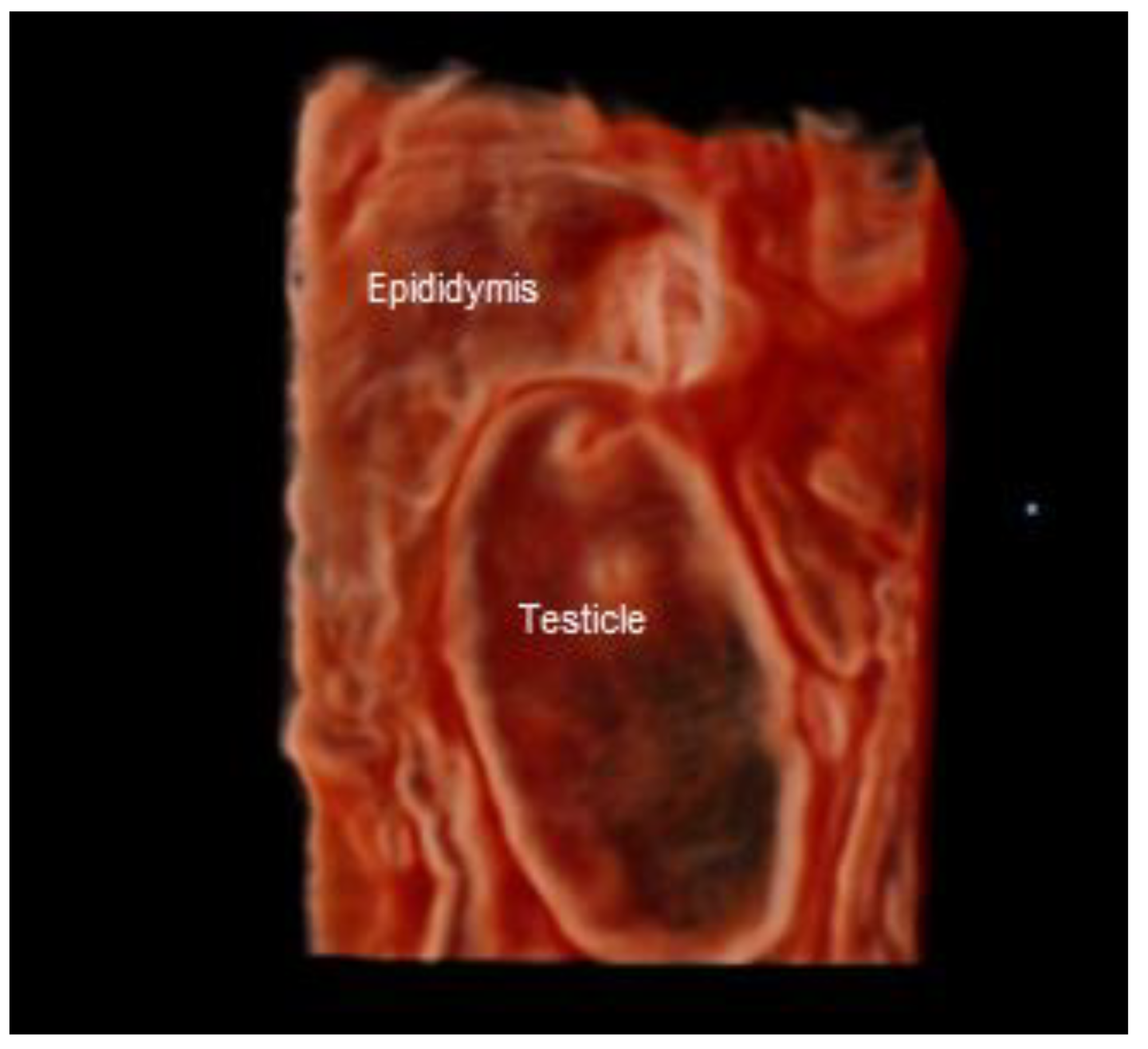 Role of Epididymis Assessment in Male Infertility Using Three ...