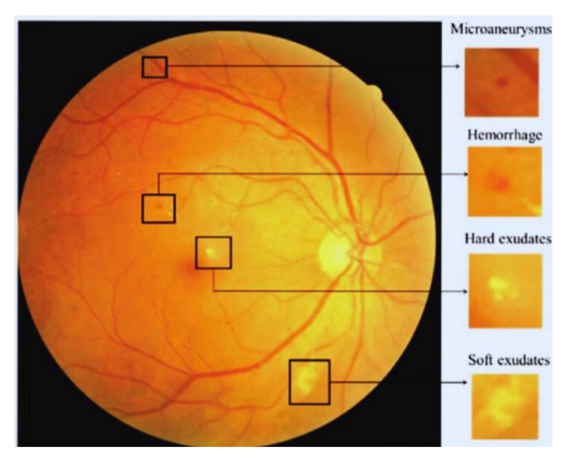 DRCCT: Enhancing Diabetic Retinopathy Classification with A Compact Convolutional Transformer[v1 ...