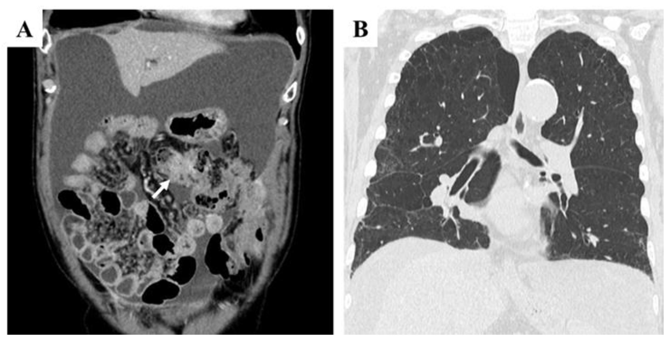 Postmortem Diagnosis of Pulmonary Tumor Thrombotic Microangiopathy in a ...