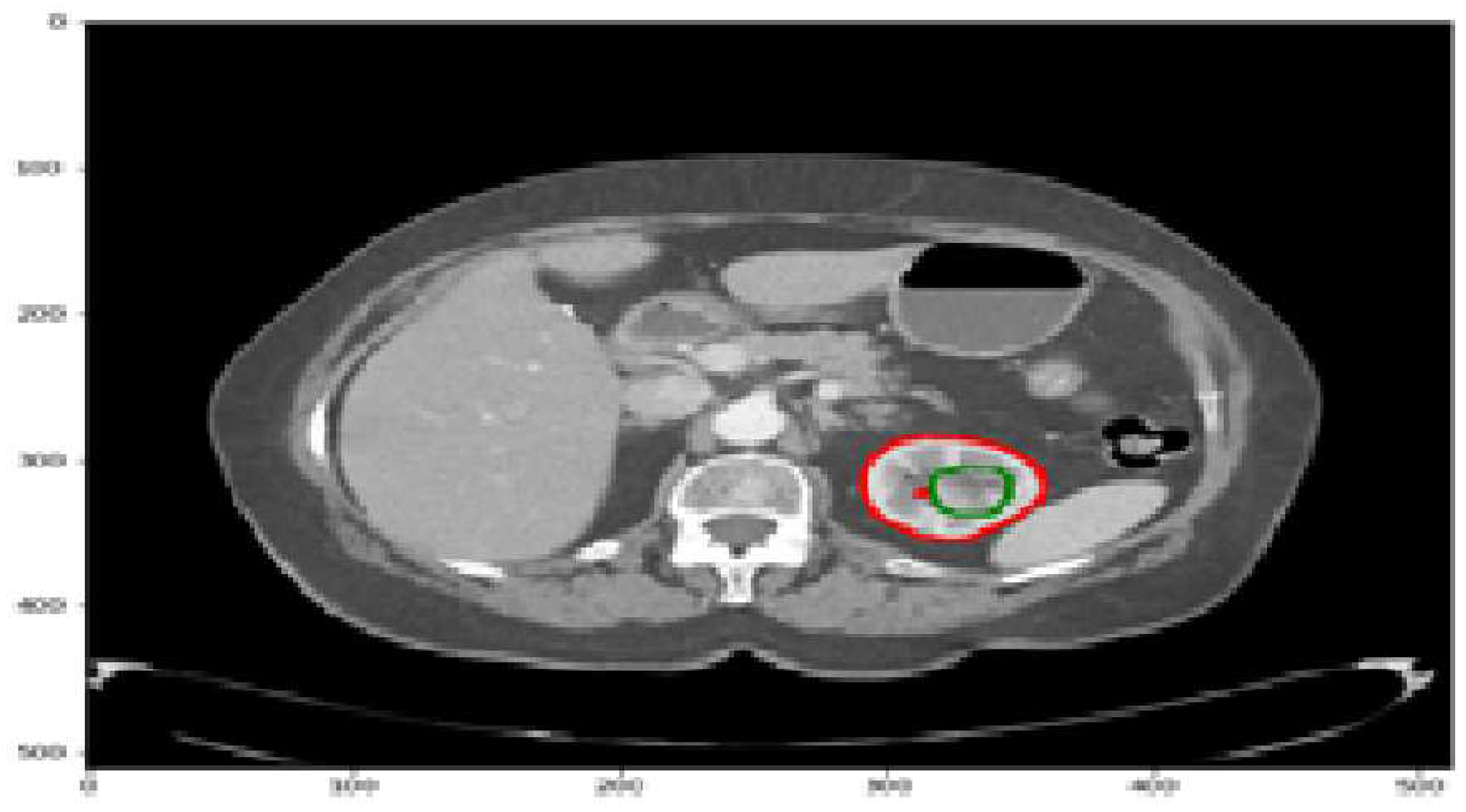 Optimizing Inference Distribution for Efficient Kidney Tumor Segmentation using a UNet-PWP Deep ...