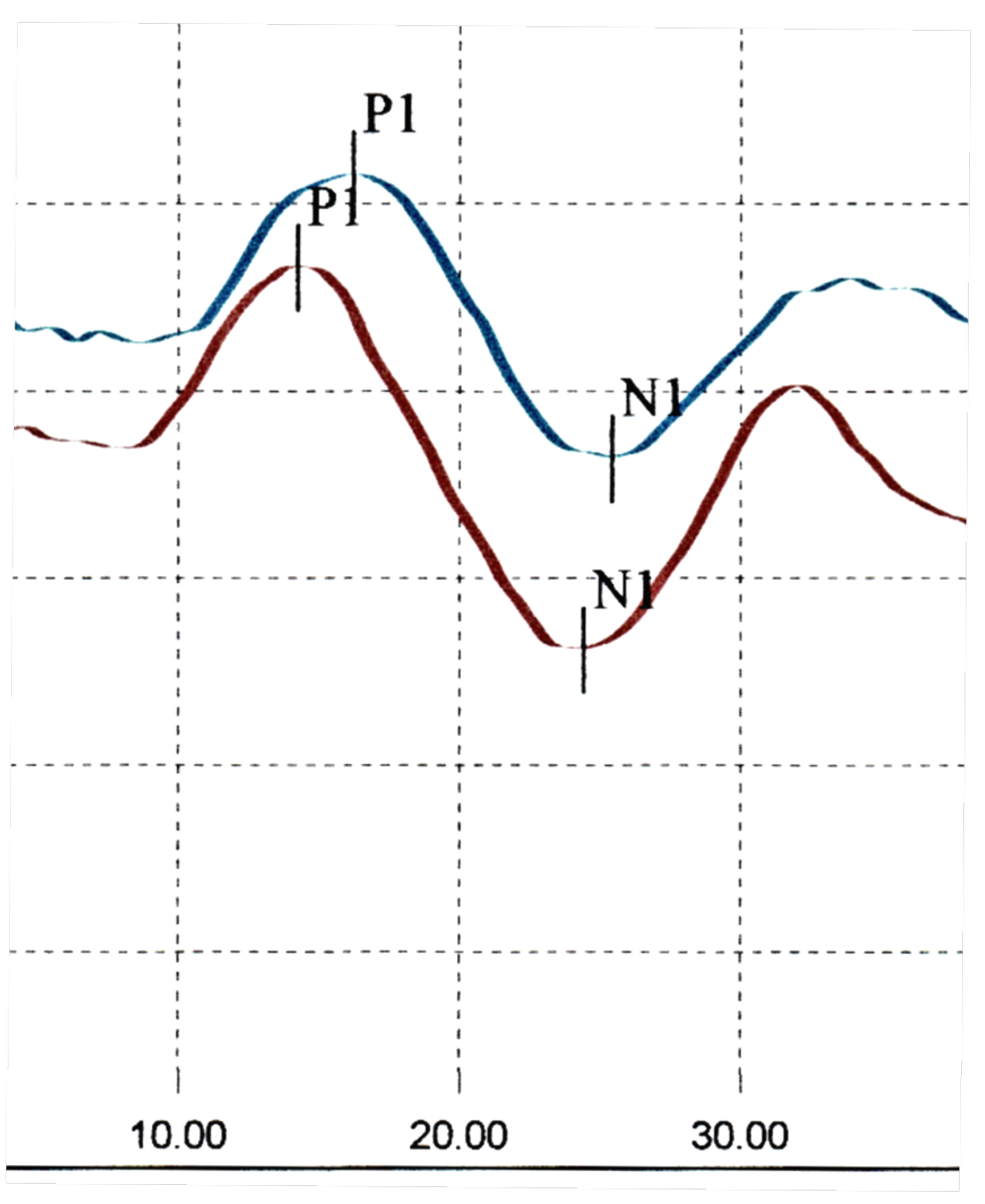 Inadvertent Dural Puncture Causing Low Pressure Headache and Peripheral ...