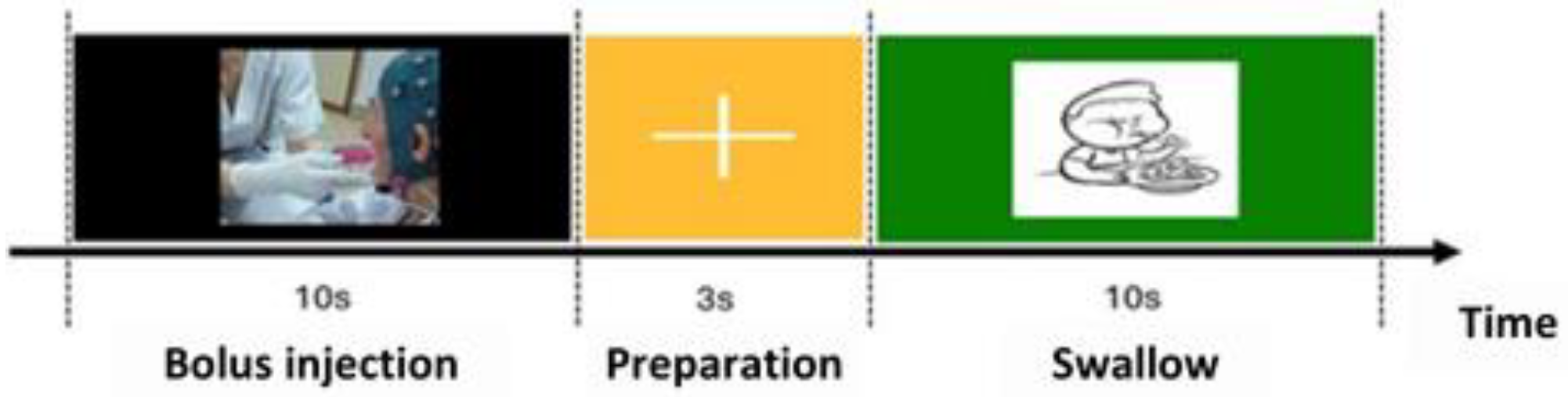 Entropy Analysis of Electroencephalographic Signals for Post-Stroke Dysphagia Assessment[v1 ...