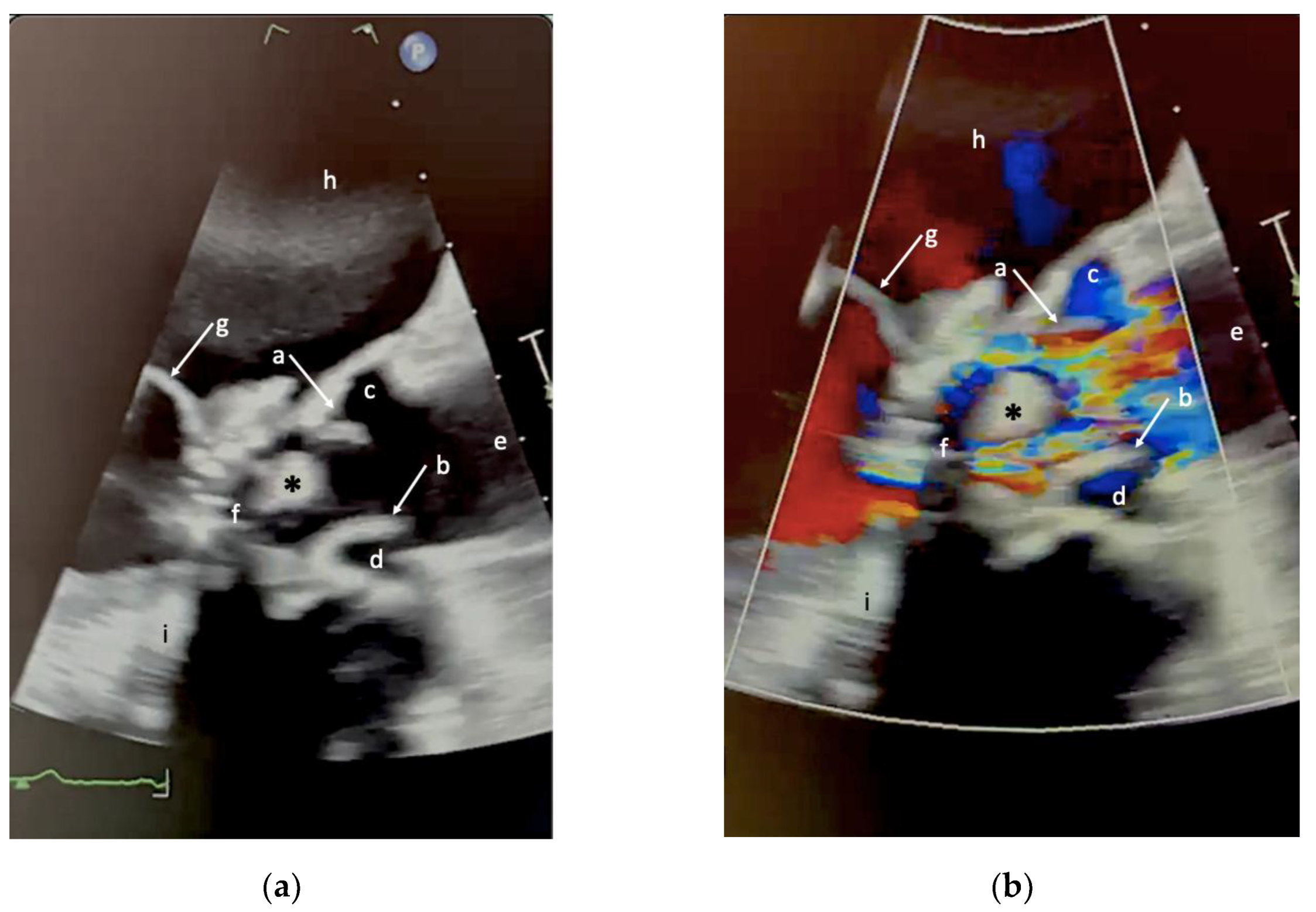 Unusual Native Valve Remnant in the Left Ventricular Outflow Tract ...