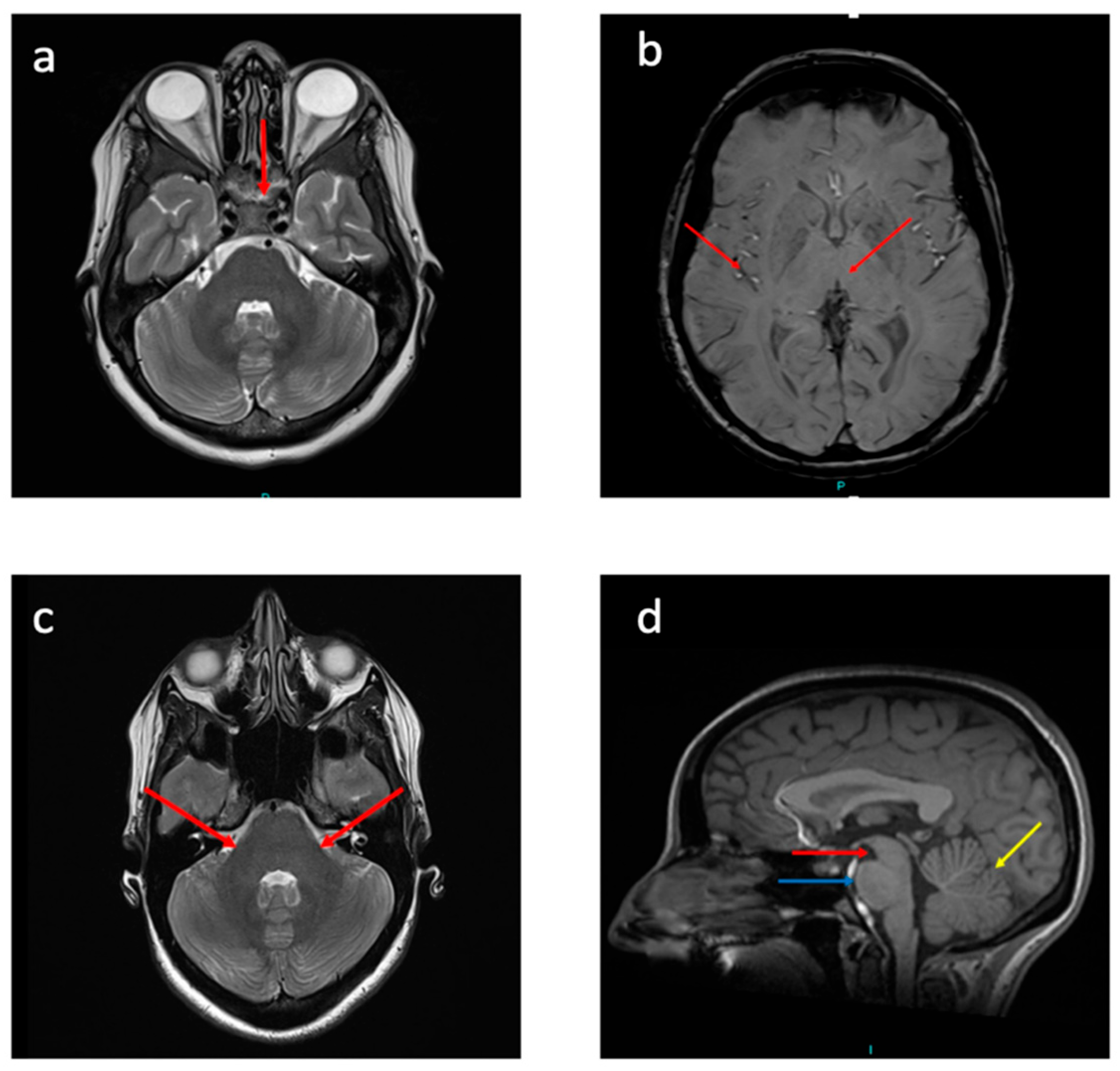 The Many Faces of Parkinsonism: Dissecting Clinical and Molecular ...