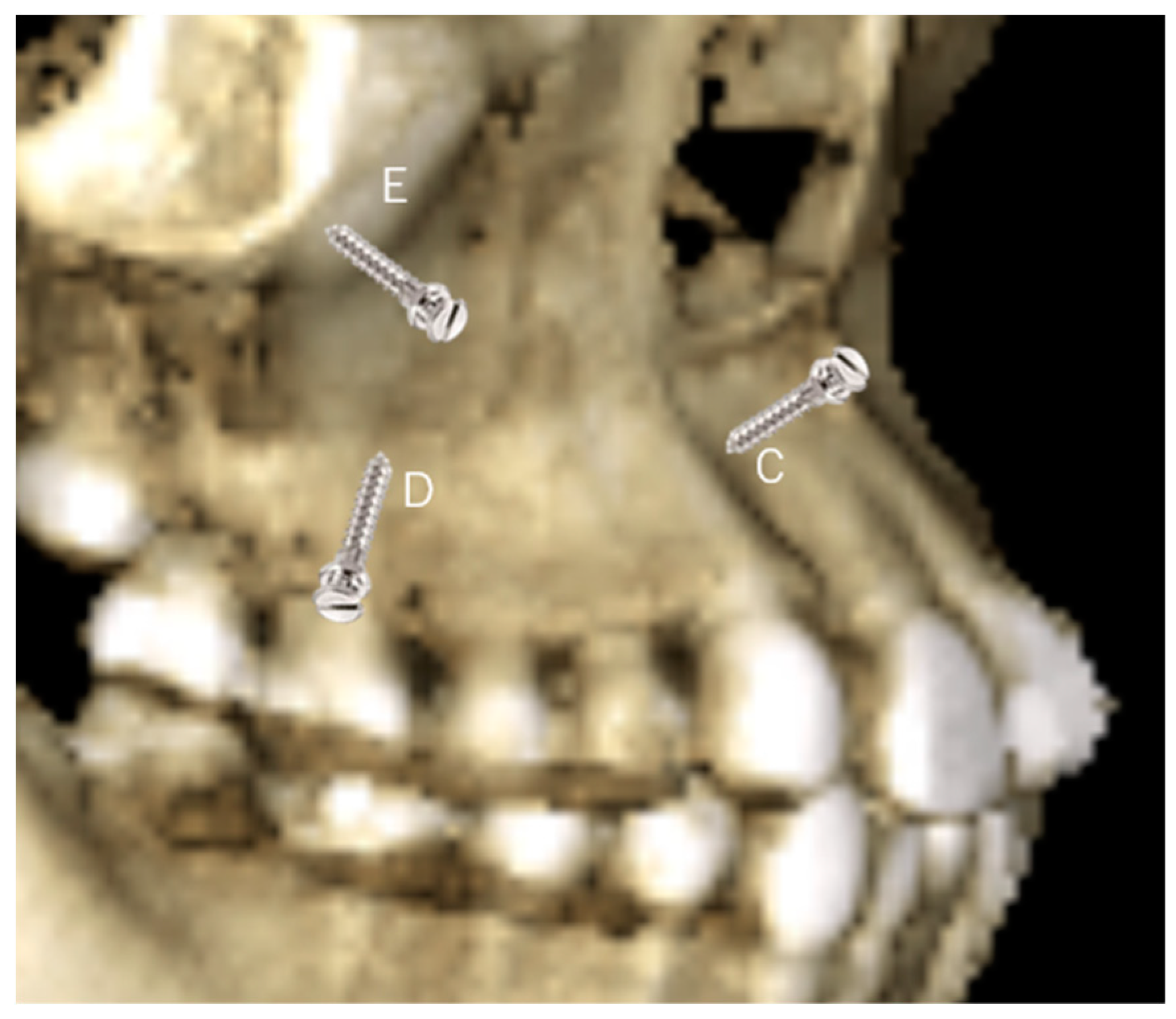 The making of Surgical Guides for TADs[v1] | Preprints.org