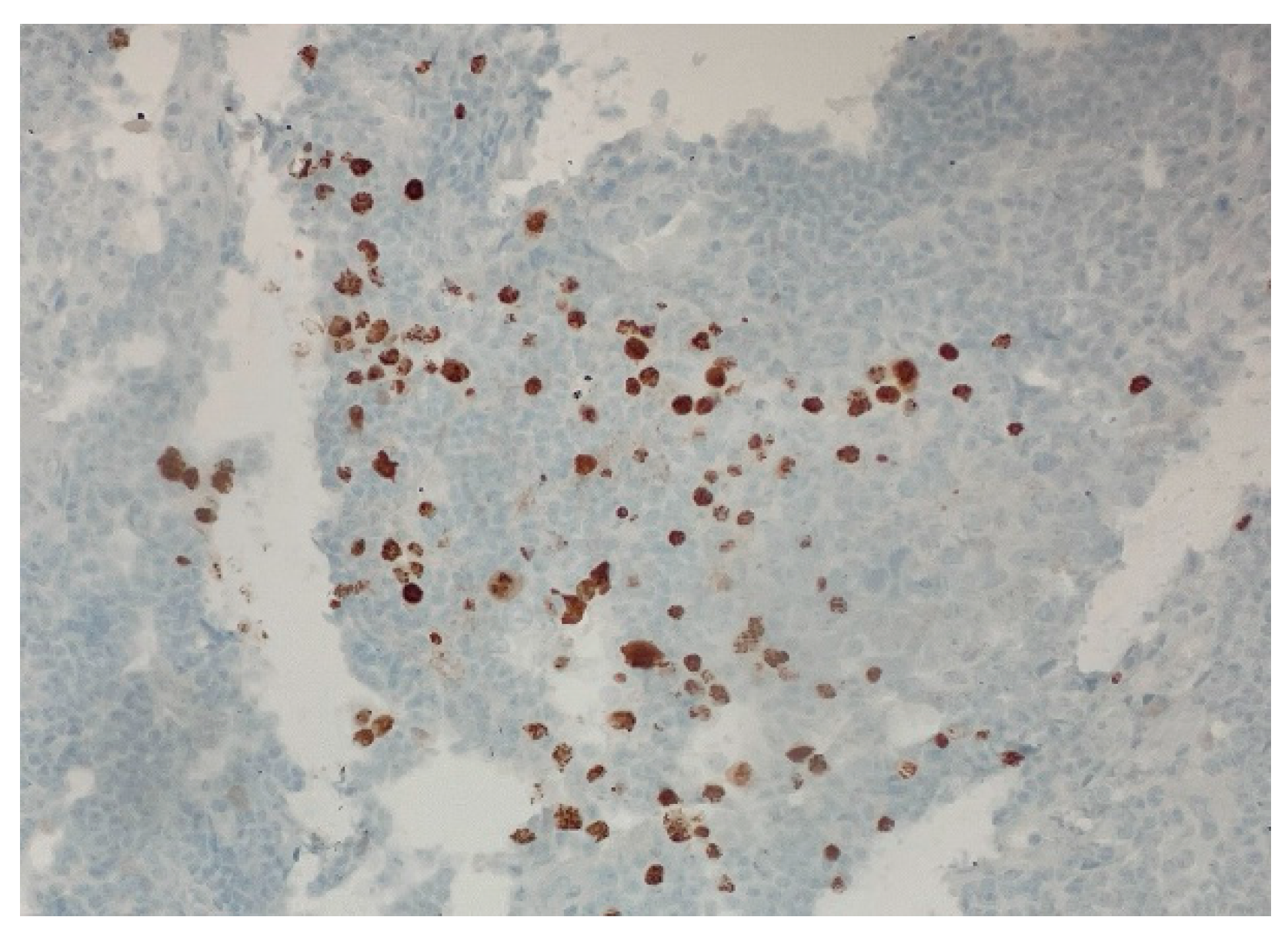 Diagnostic Challenges in HHV-8-Associated Multicentric Castleman’s ...