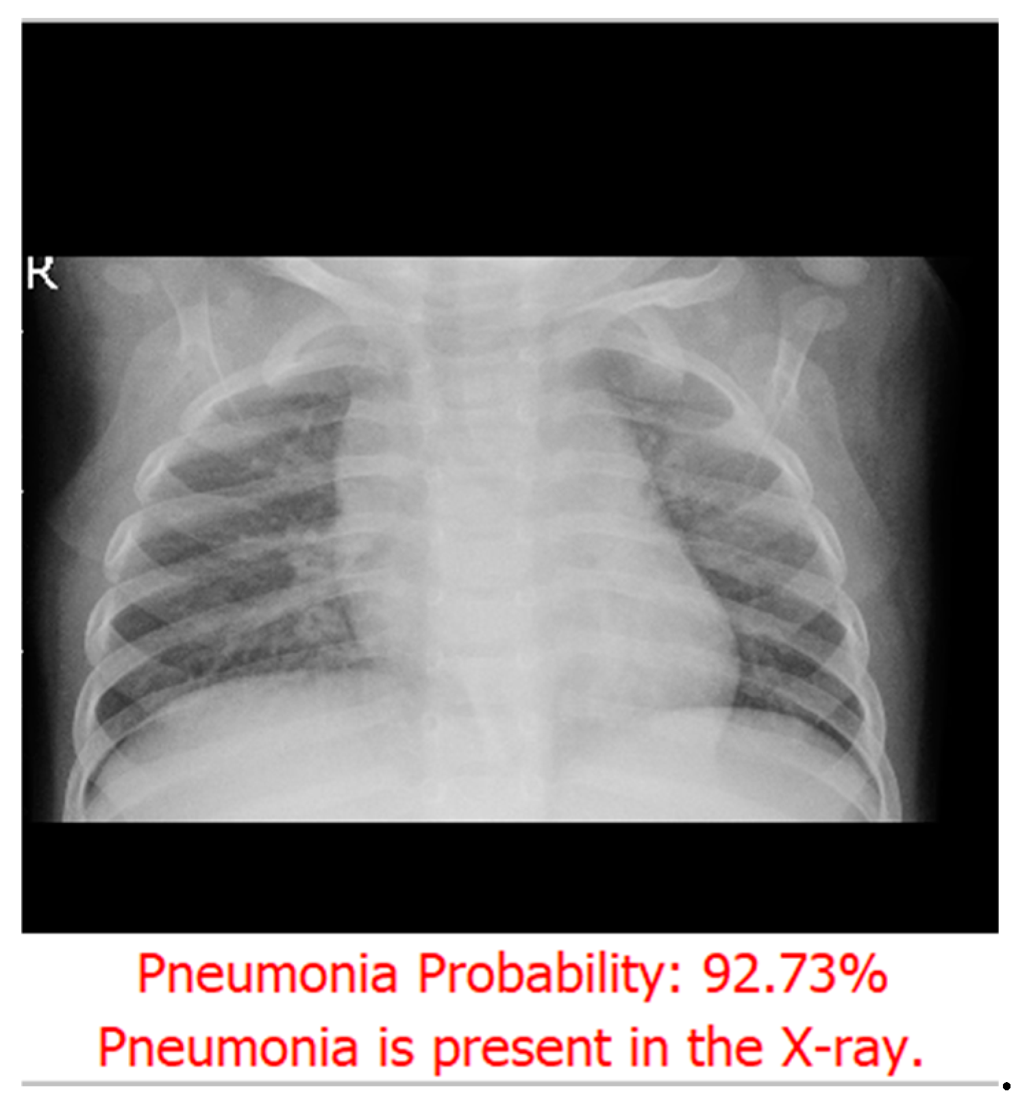 Pneumonia Detection from Chest X-rays Using the CheXNet Deep Learning Algorithm[v1] | Preprints.org