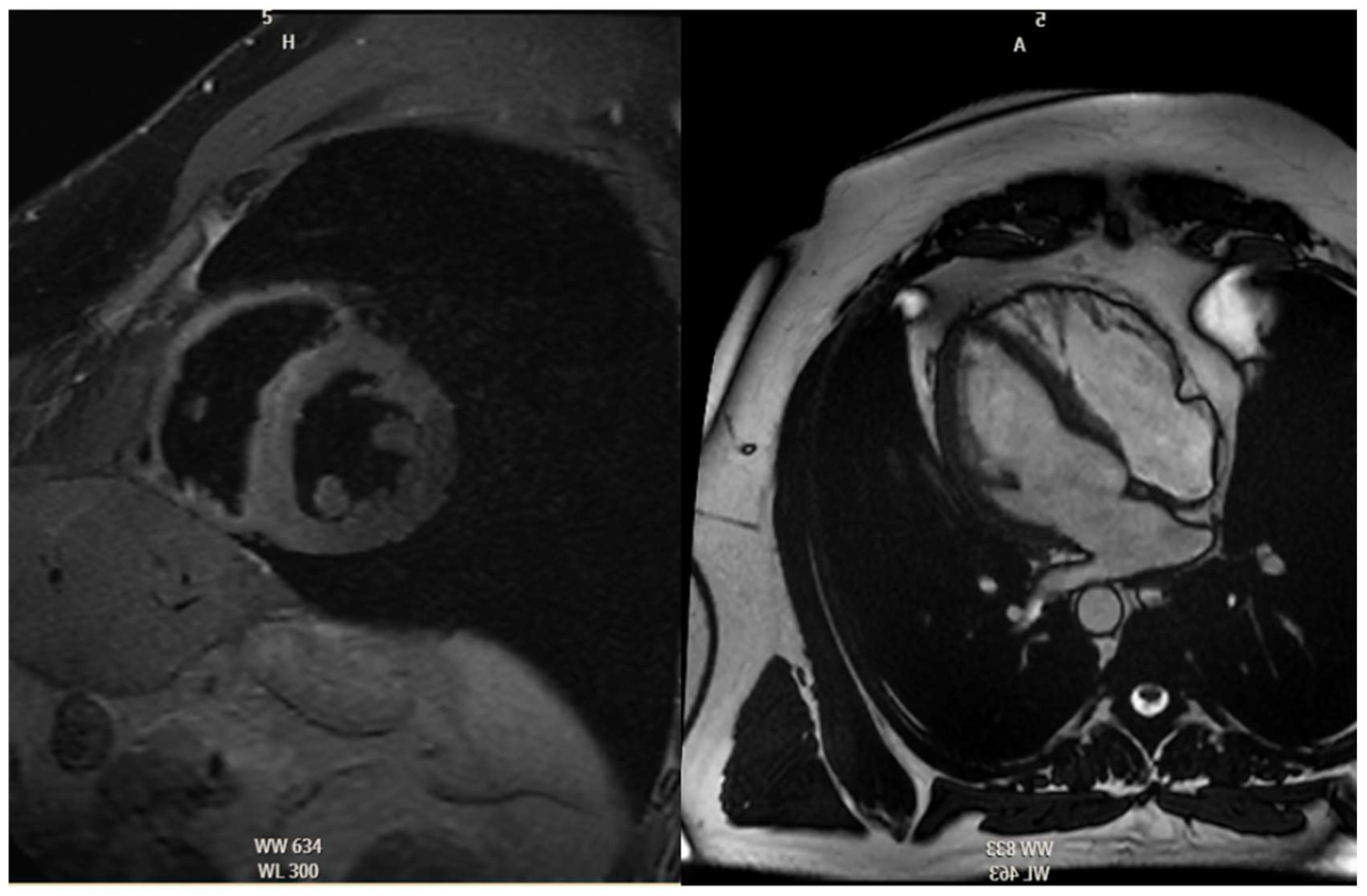Arrhythmogenic Right Ventricular Cardiomyopathy: A Comprehensive Review ...