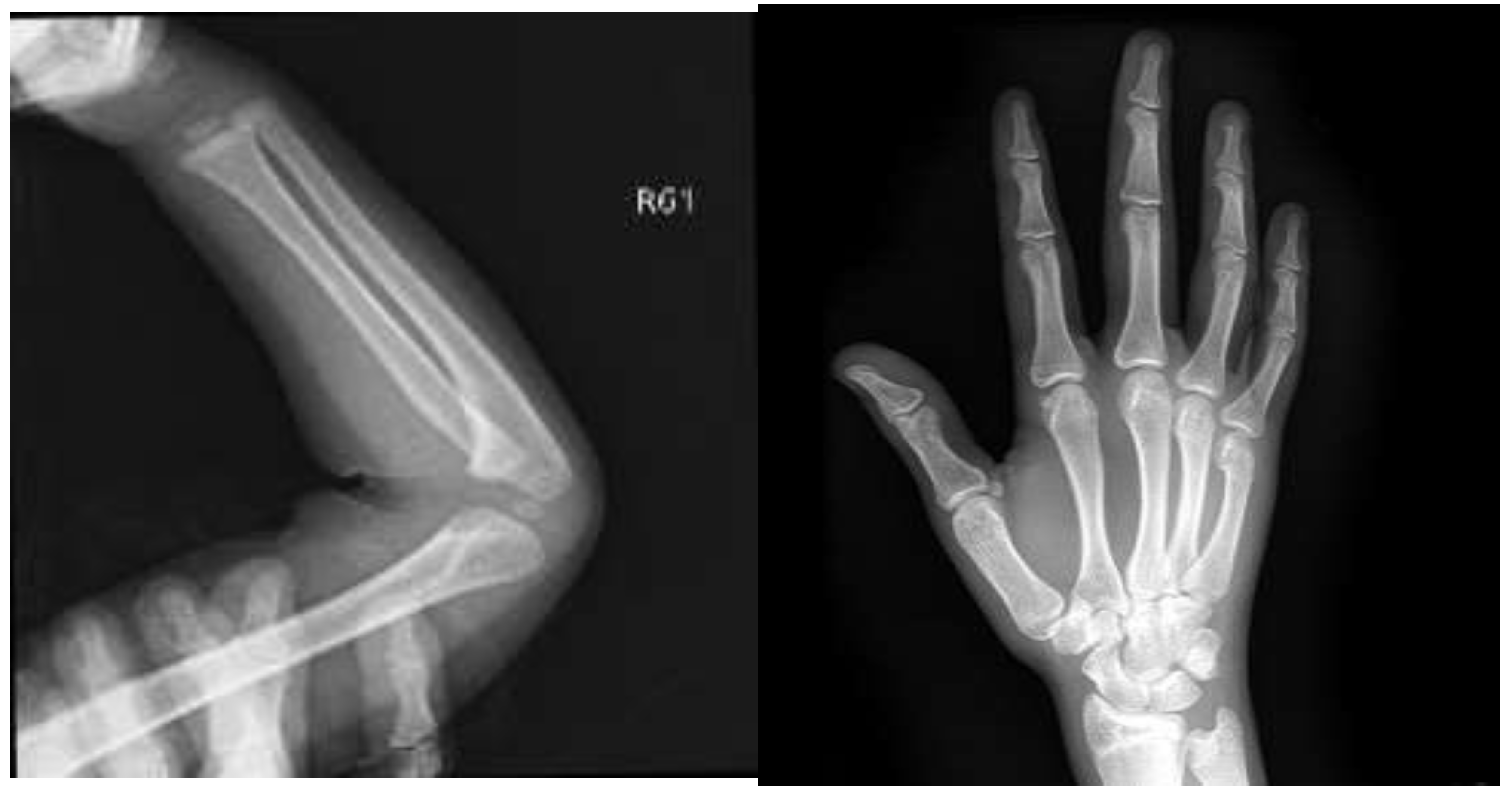 Bone Fracture Detection from X-ray Images using a Convolutional Neural Network (CNN)[v1 ...