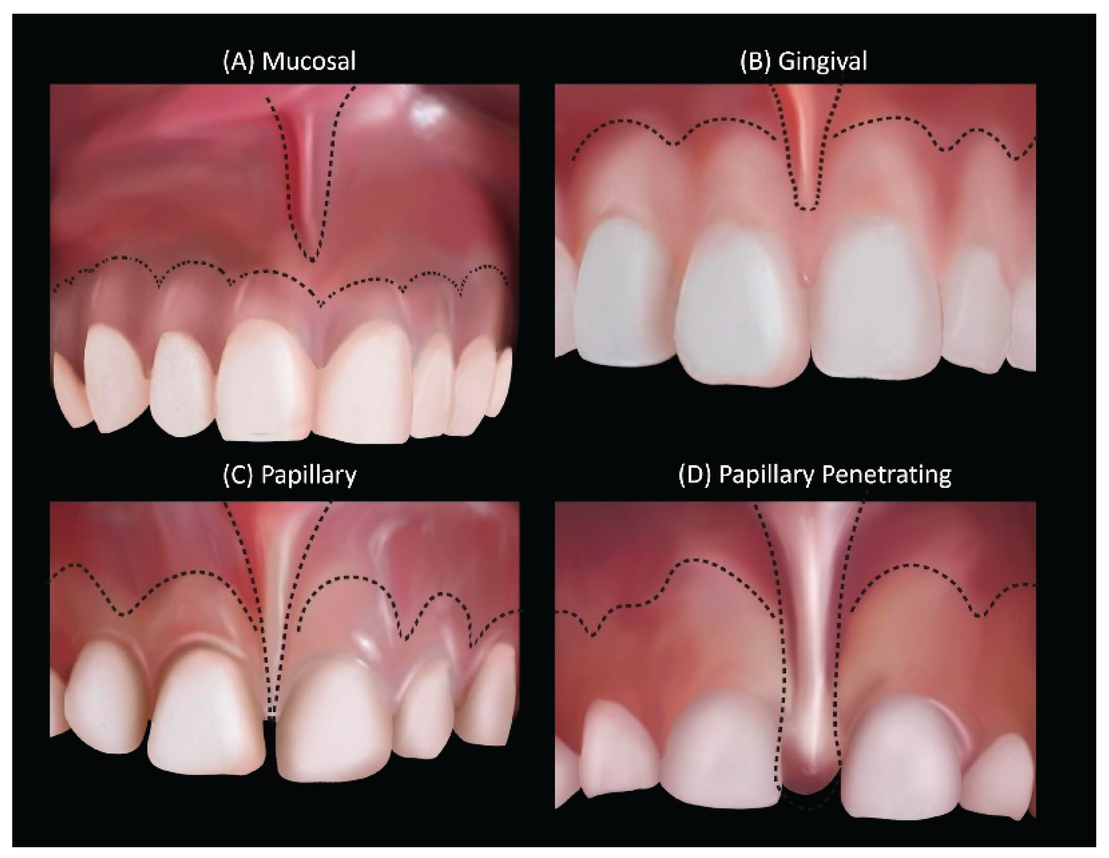 Morphology of the Labial Frenum by Age-Cohort: A Cross-Sectional Study ...