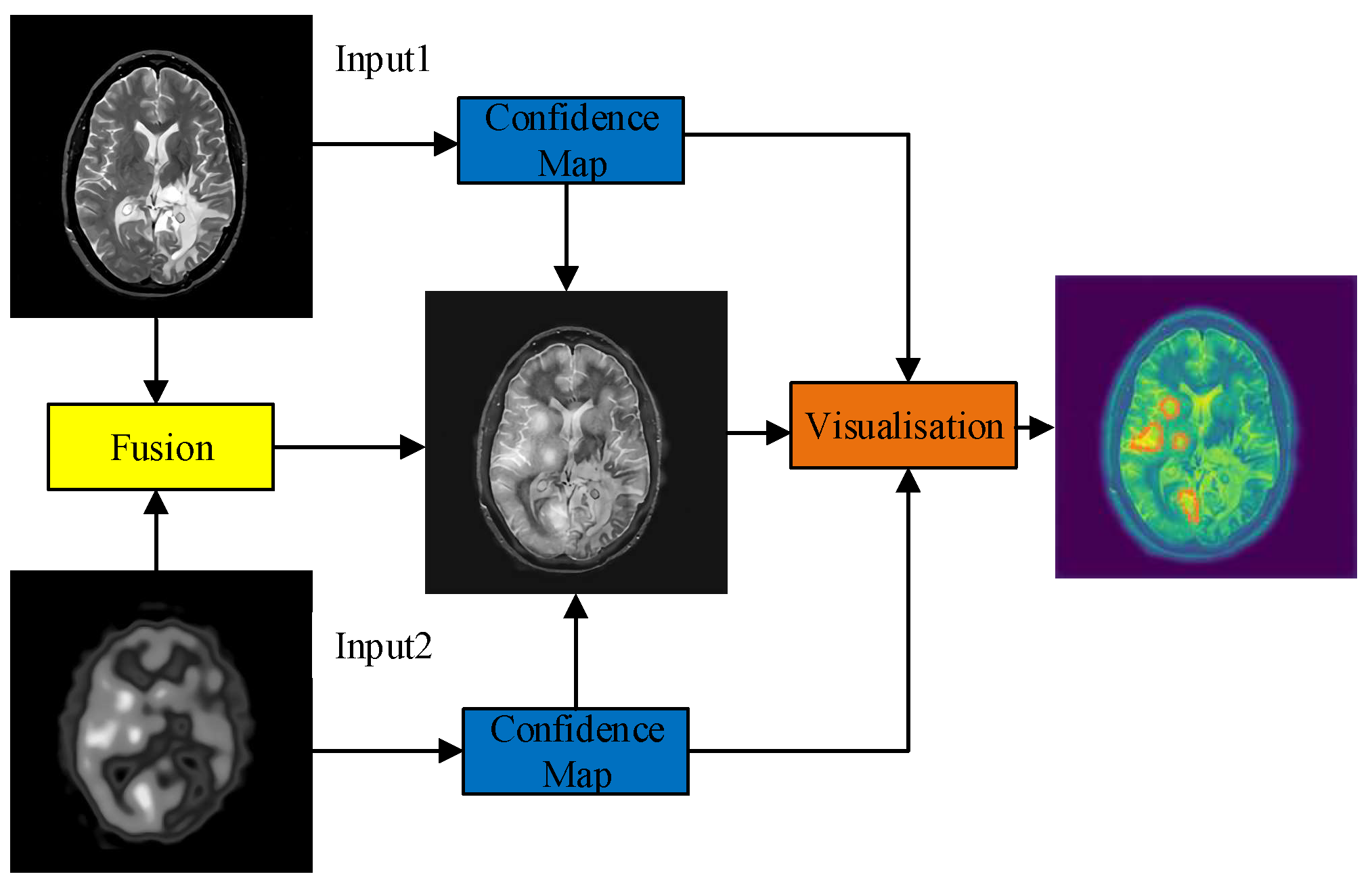 Multimodal Brain Image Fusion Algorithm Based on Multiscale Contextual Inference[v1] | Preprints.org