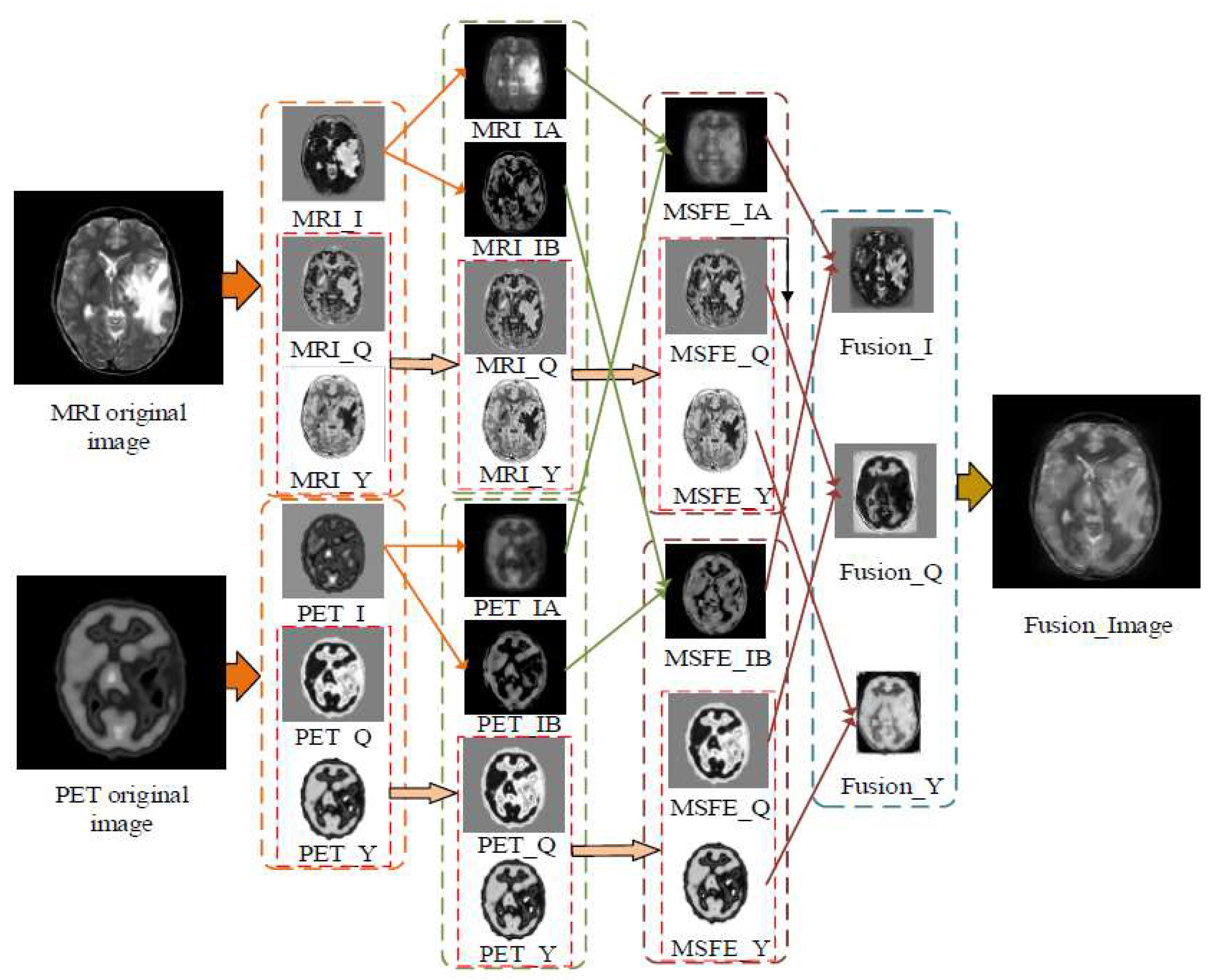 Multimodal Brain Image Fusion Algorithm Based on Multiscale Contextual Inference[v1] | Preprints.org