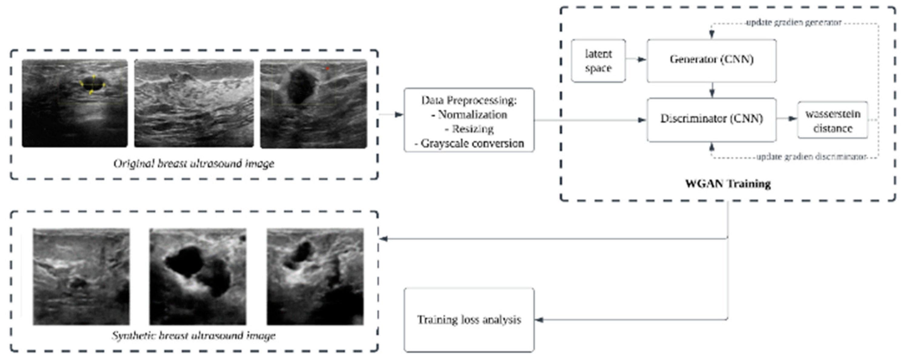Data Augmentation of Breast Ultrasound Images Using Wasserstein Generative Adversarial Networks ...