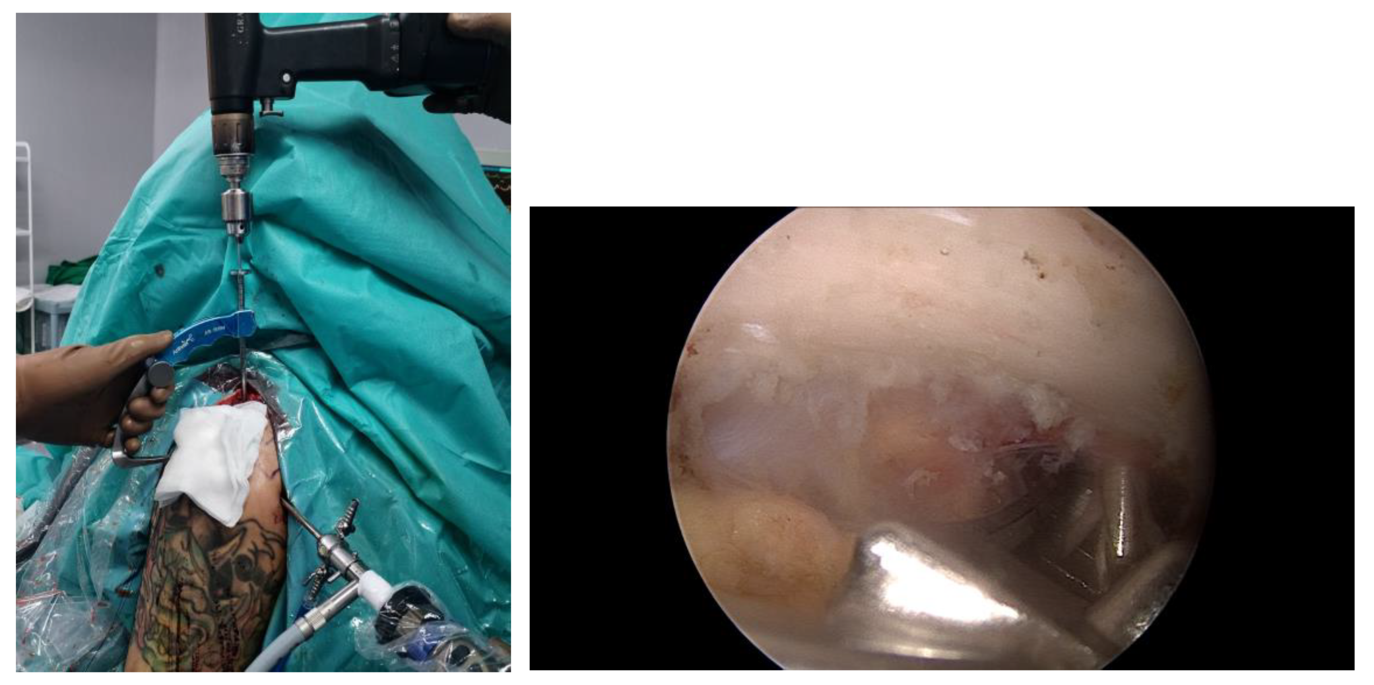 Advantages and Disadvantages of the Arthroscopic Procedure[v1 ...