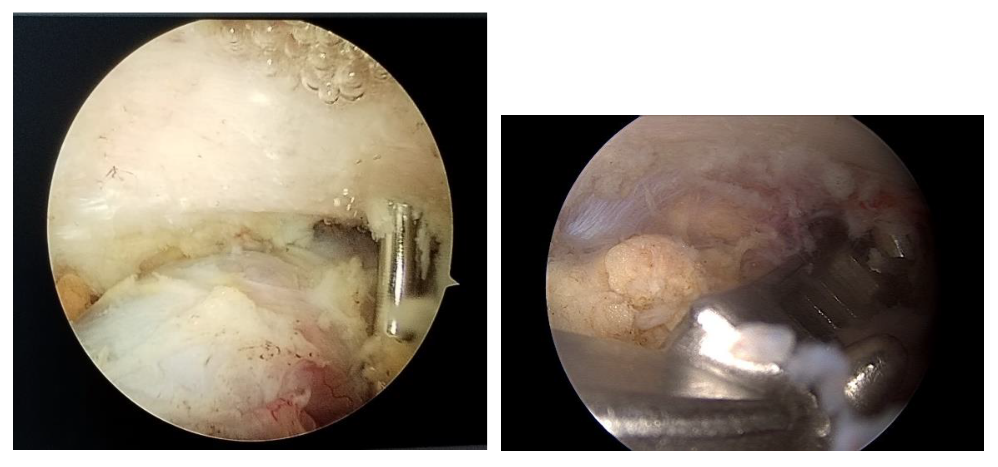 Advantages and Disadvantages of the Arthroscopic Procedure[v1 ...