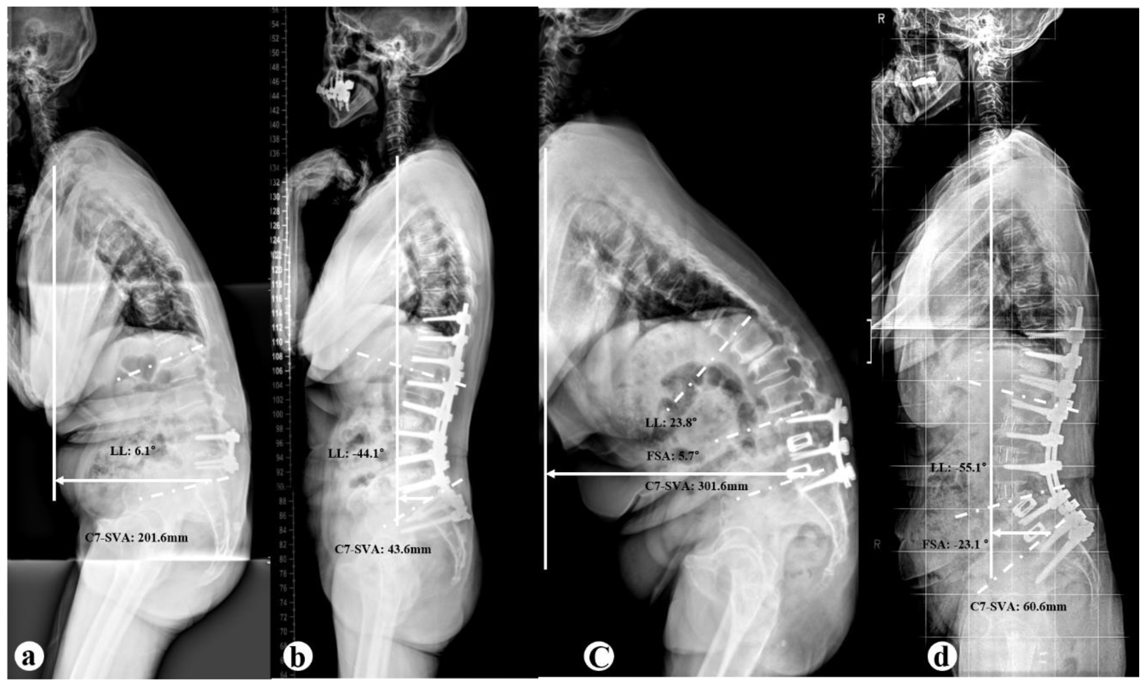 Indications for Additional Pedicle Subtraction Osteotomy in Iatrogenic ...