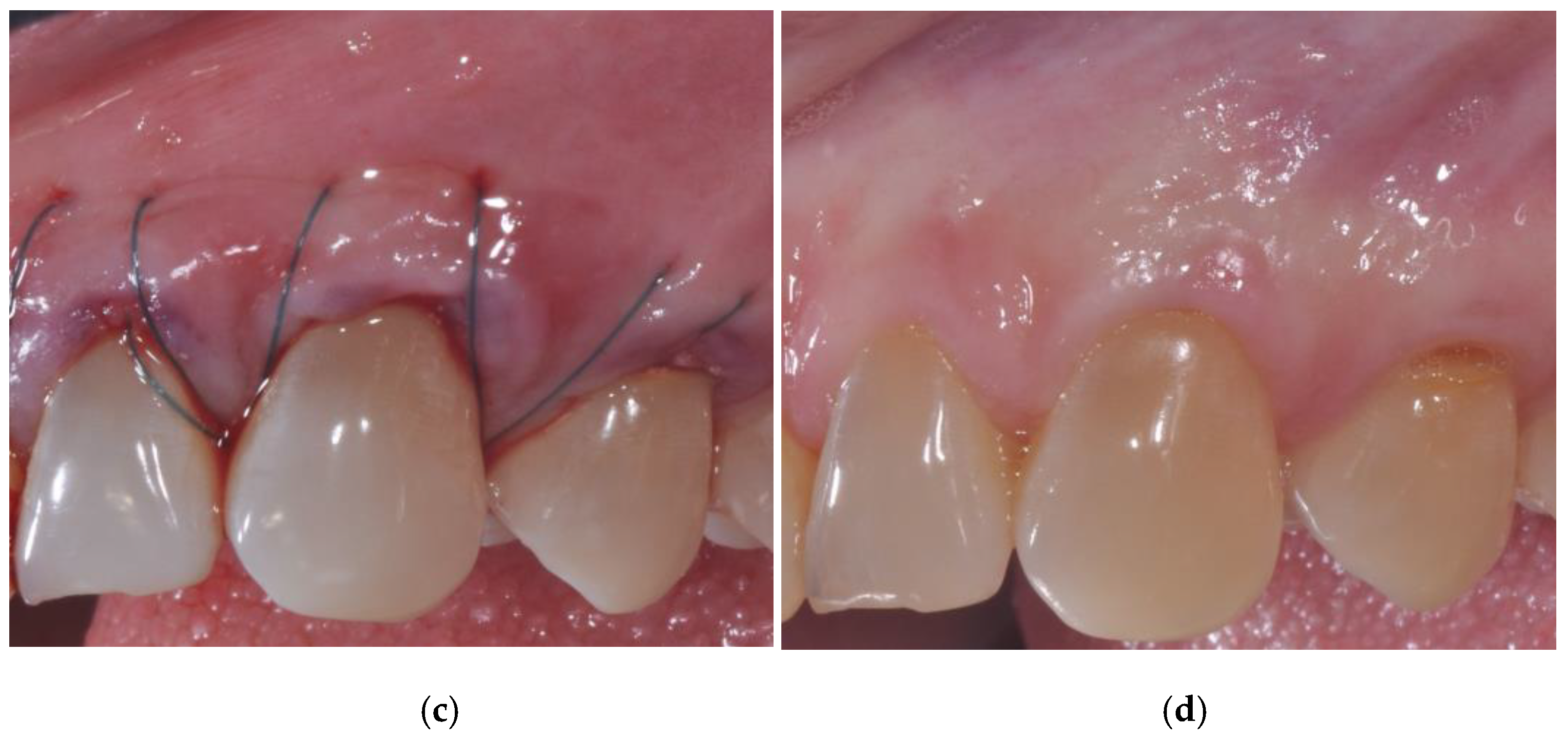 Root Coverage Using the Coronally Positioned Tunnel Technique with Acellular Dermal Matrix ...