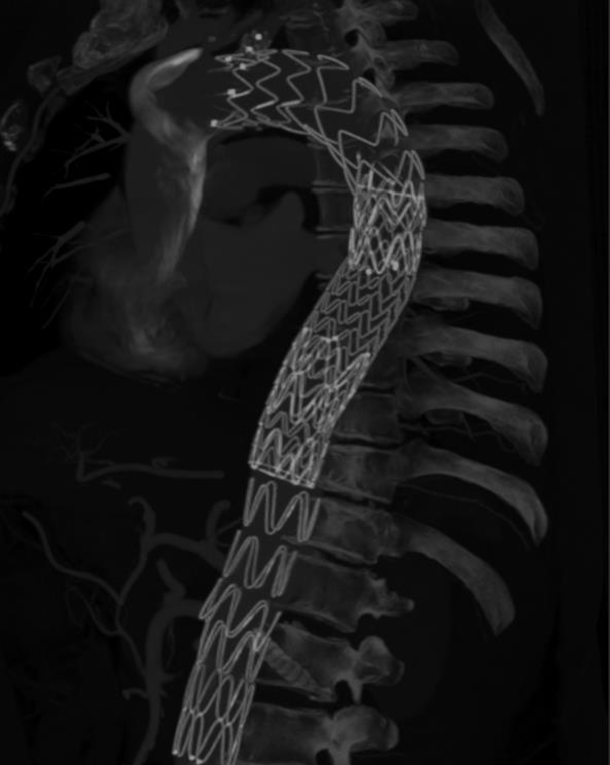 Dedicated Single-Branch Platforms for Totally Endovascular Zone 2 TEVAR ...