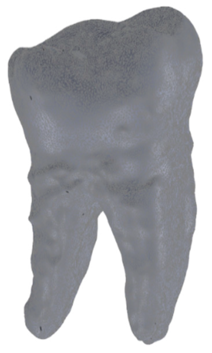 Biomechanical Response of Class II MOD Restorations Con-Sidering ...