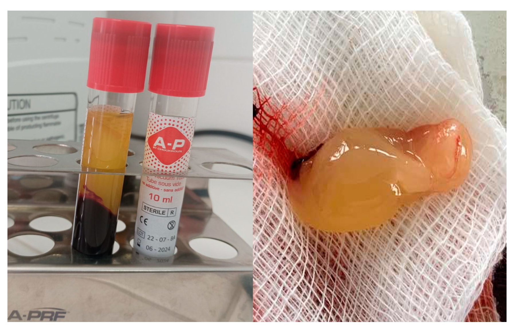 Biological Enhancement of Gingival Phenotype Using Injectable PRF – A ...