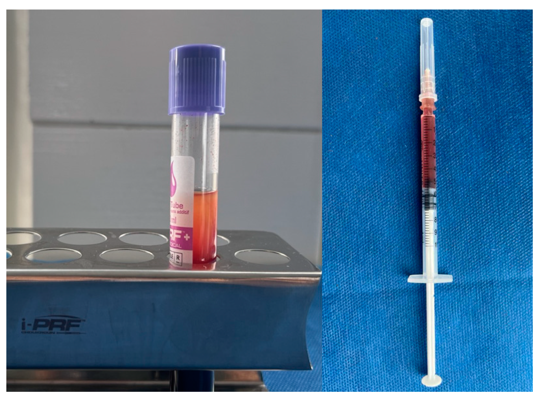 Biological Enhancement of Gingival Phenotype Using Injectable PRF – A ...