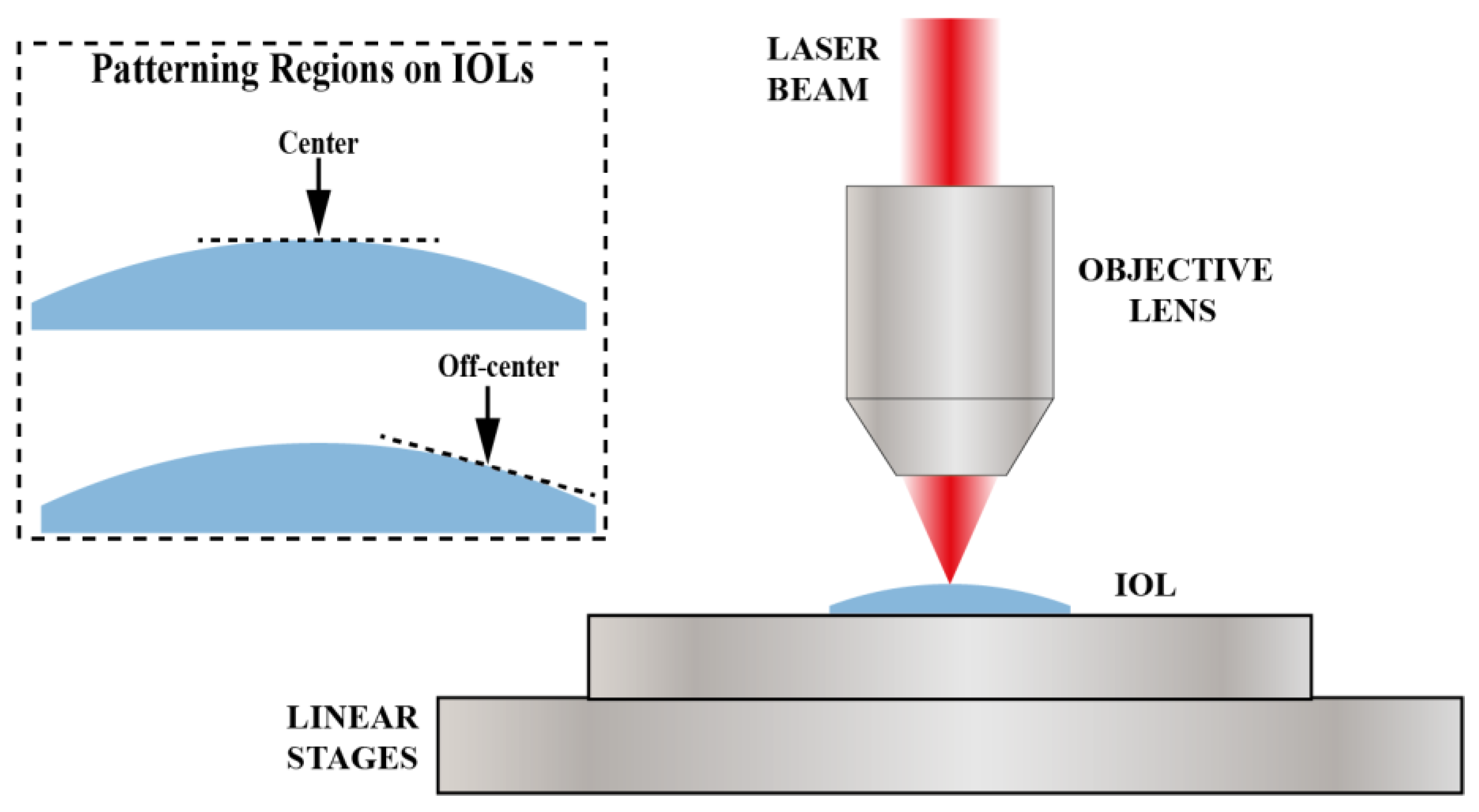 Laser Processing of Intraocular Lenses[v1] | Preprints.org