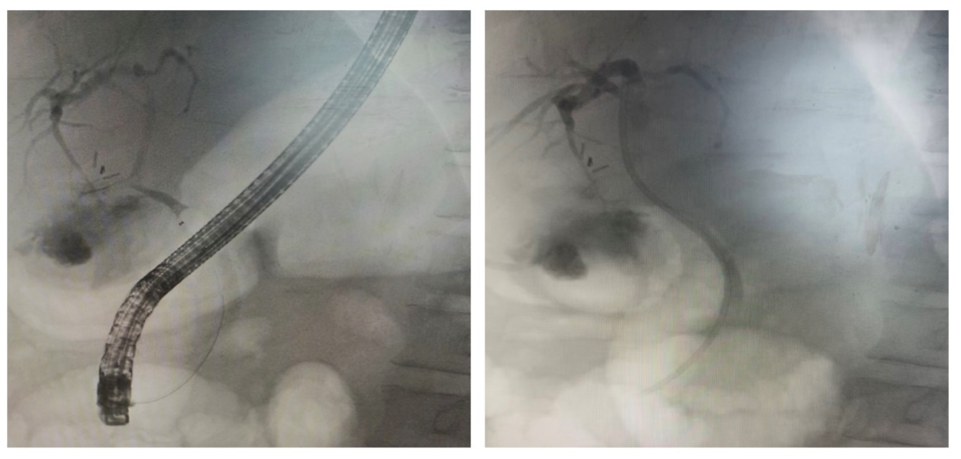Endoscopic Biodegradable Biliary Stent in Complex Bile Duct Injury ...