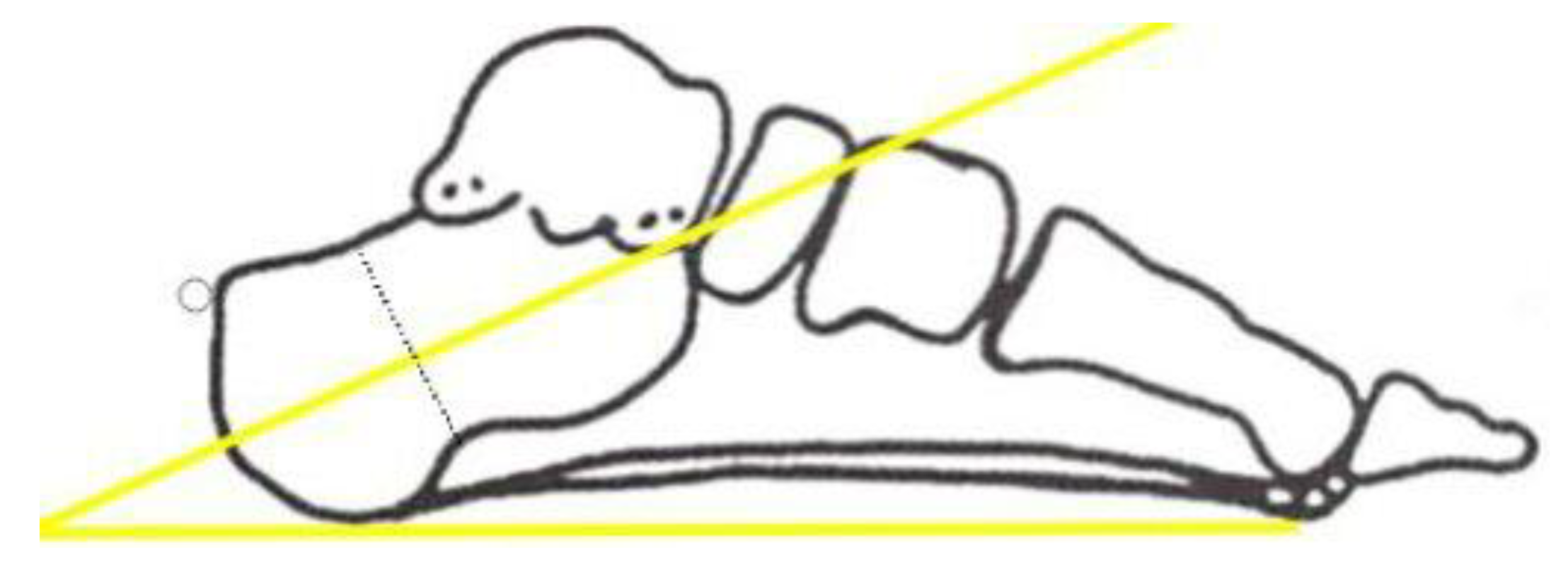 Comparison of Medium-Term Efficacy of Japas Osteotomy and First ...