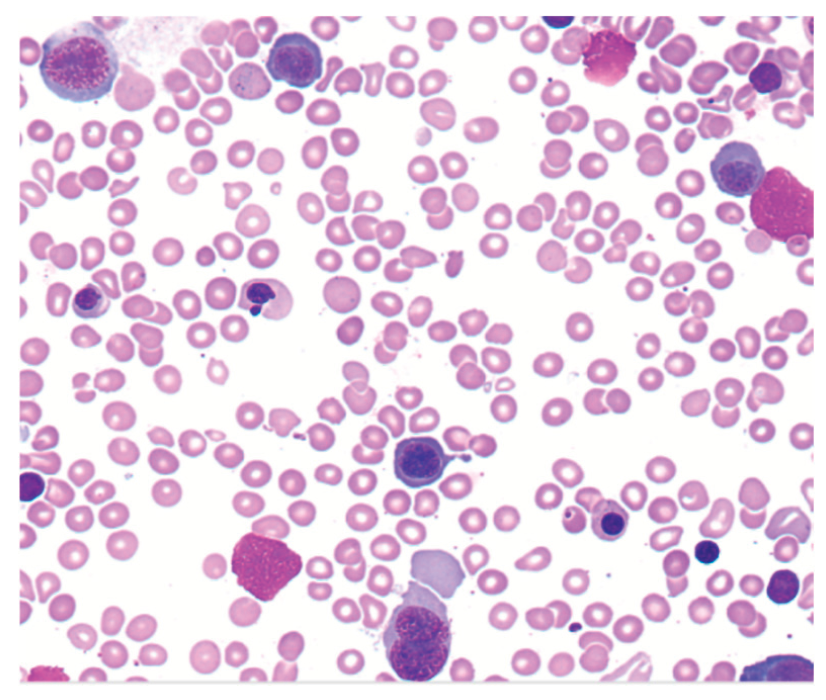 Importance of Vitamin Suppletion During Pregnancy: Pancytopenia in a 3 ...