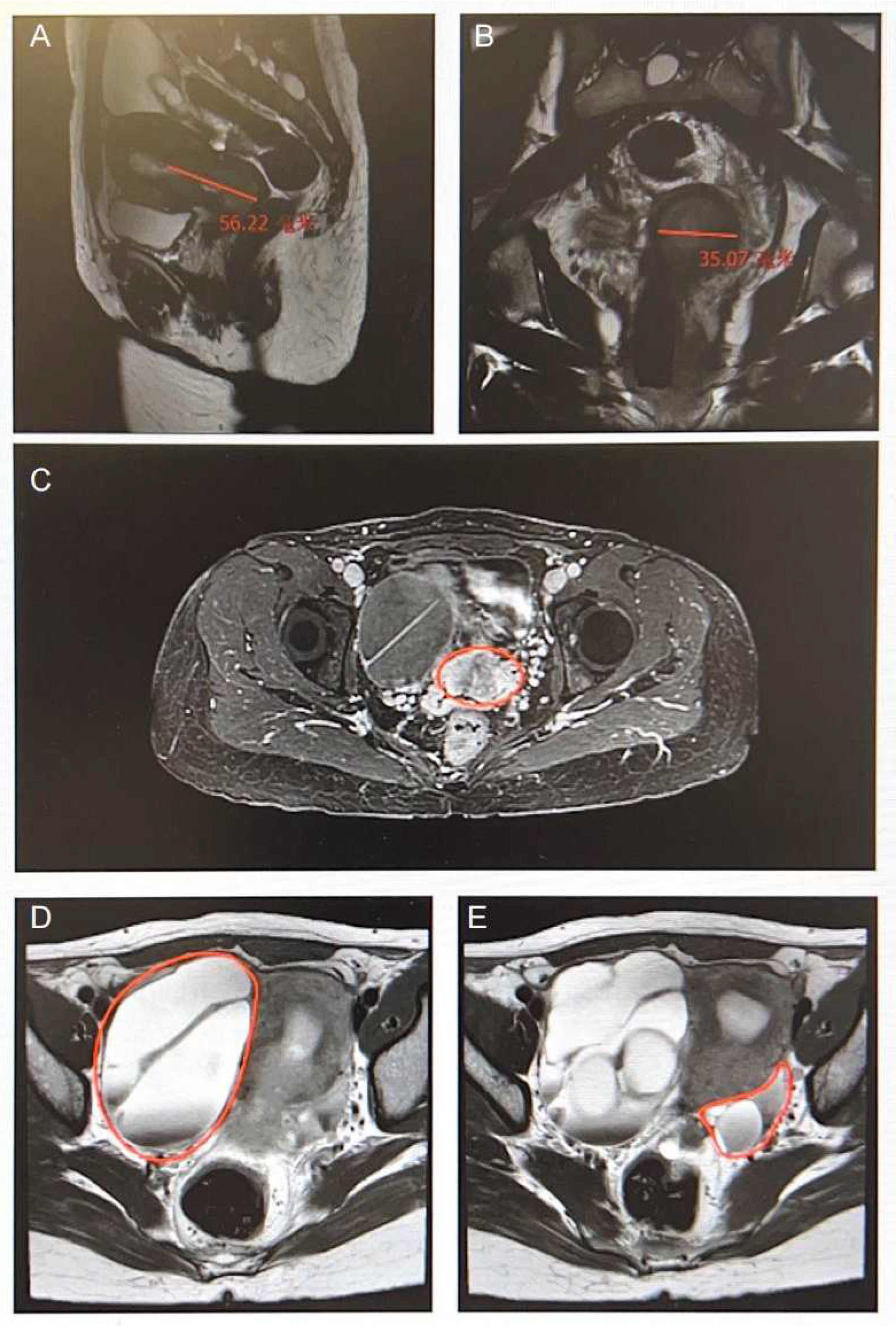 A Case Report of Gastric-Type Endocervical Adenocarcinoma Accompanied ...