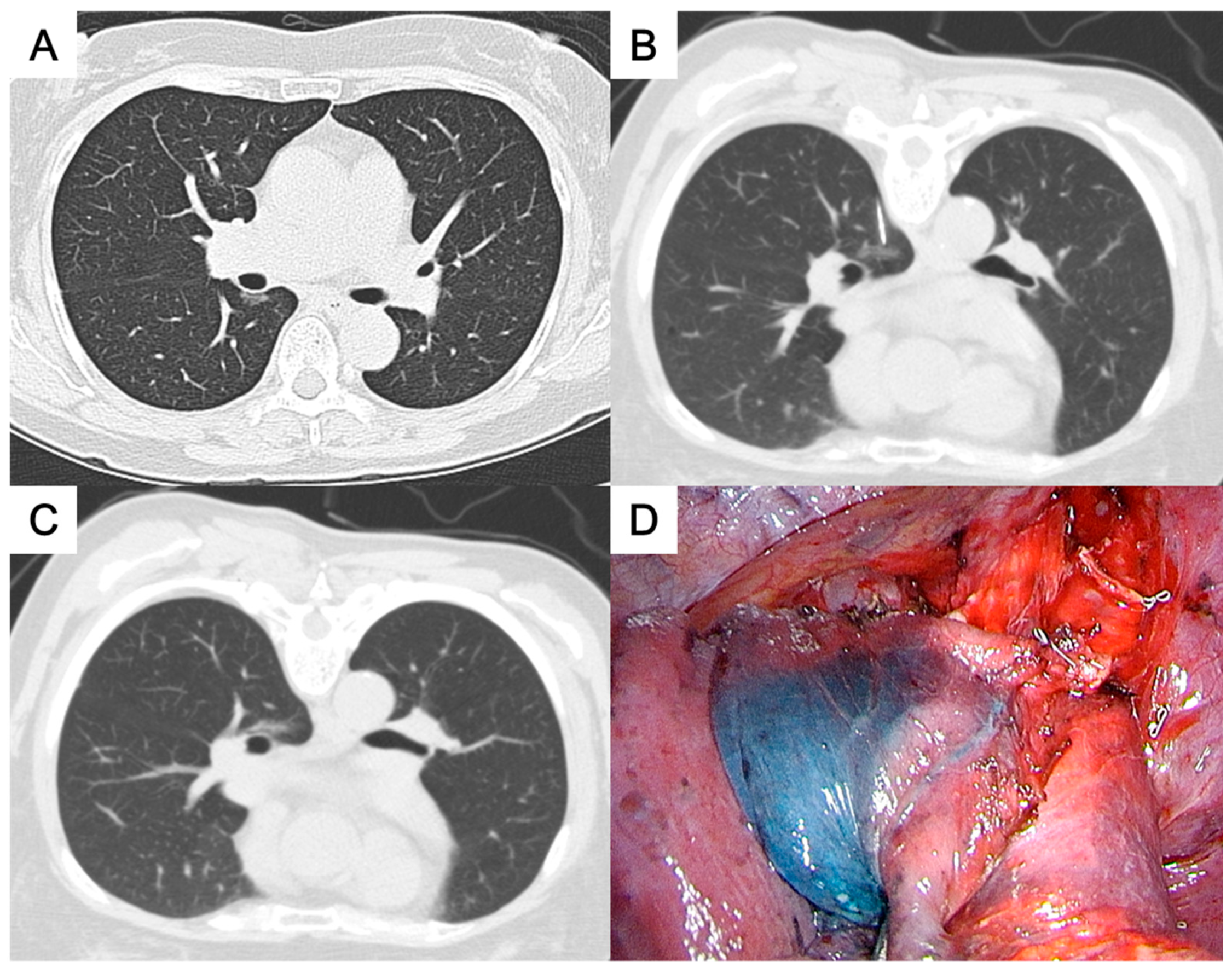 Efficacy and Safety of CT-Guided Patent Blue Injection to Localize Deep ...