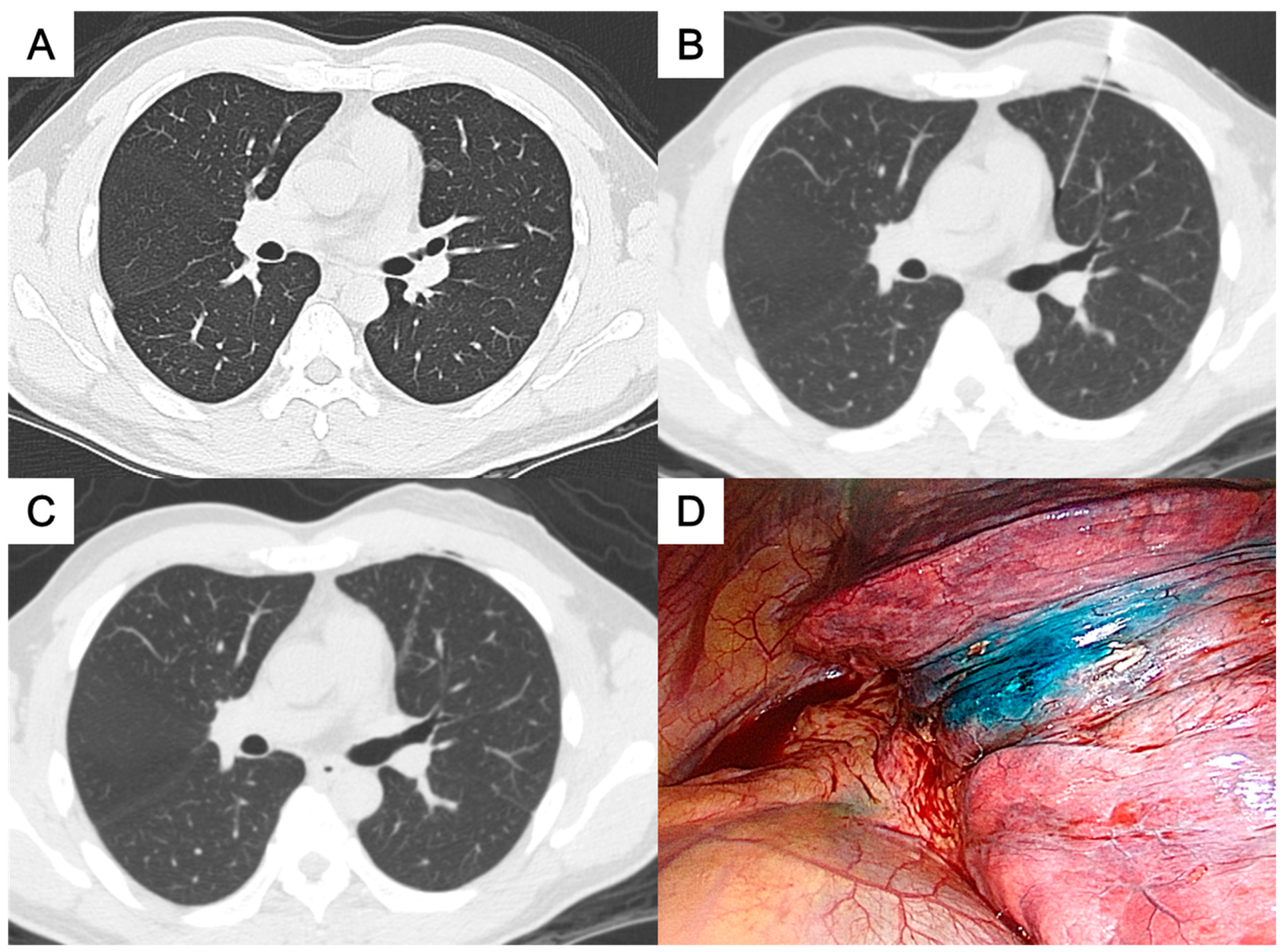 Efficacy and Safety of CT-Guided Patent Blue Injection to Localize Deep ...