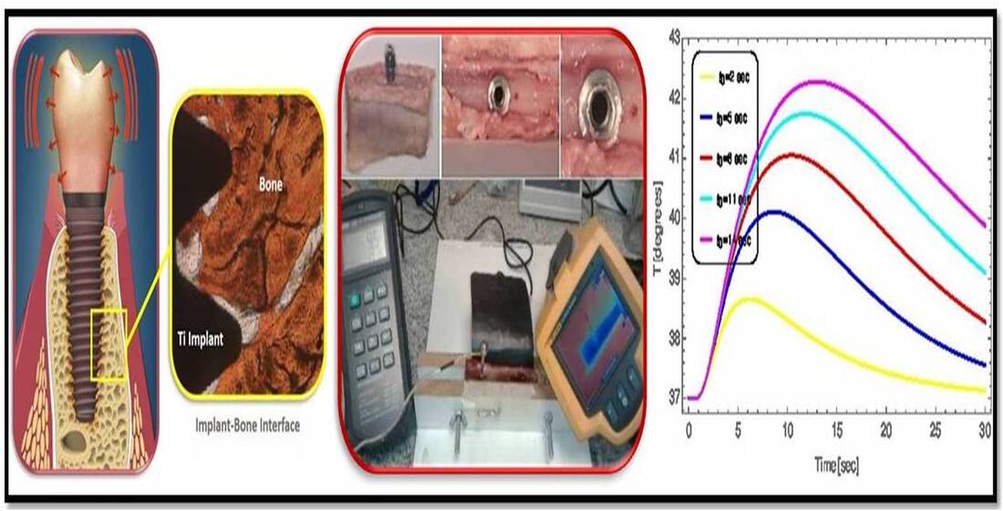 Thermal Load and Heat Transfer in Dental Titanium Implants: an Exact ...