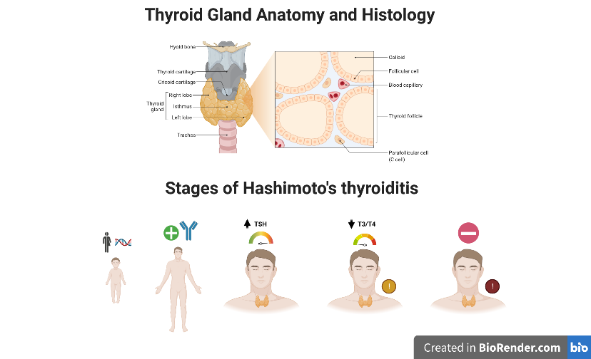 Hashimoto's Thyroiditis Autoimmune Disease: Background and Current ...