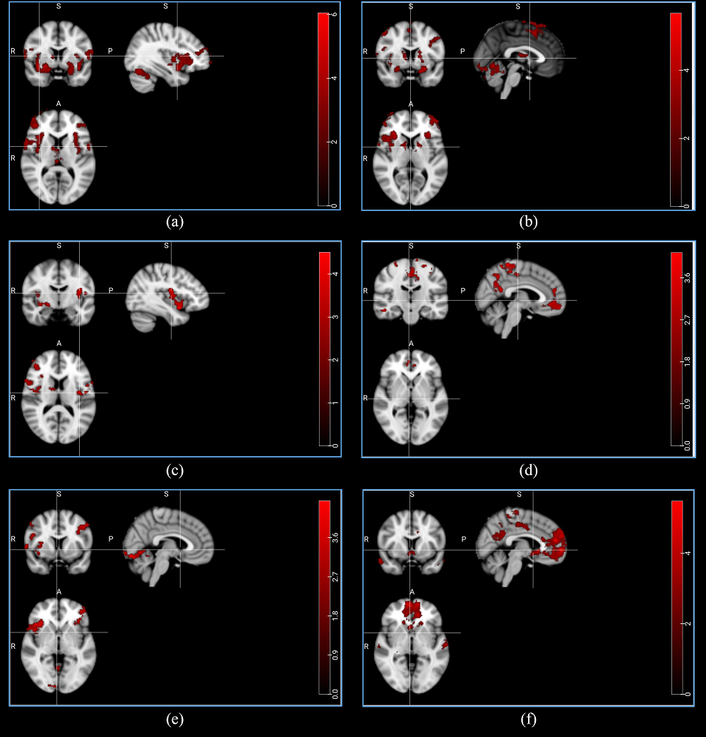 A Different Olfactory Perception in Anosmic Patients: Evidence from ...