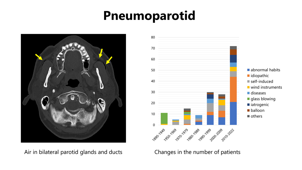 Etiology of Pneumoparotid: A Systematic Review[v1] | Preprints.org