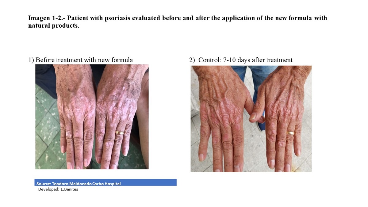 Plaque Psoriasis: Effectiveness and Therapeutic Safety Using a Topical ...
