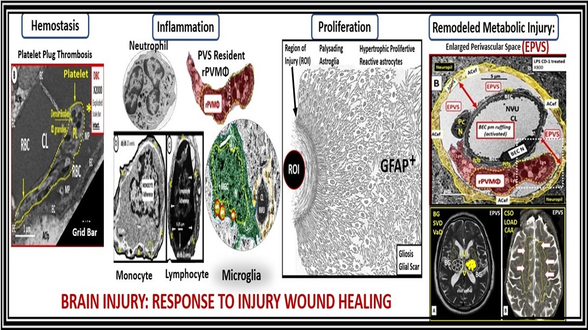 Brain Injury: Response to Injury Wound Healing Mechanisms and Enlarged ...