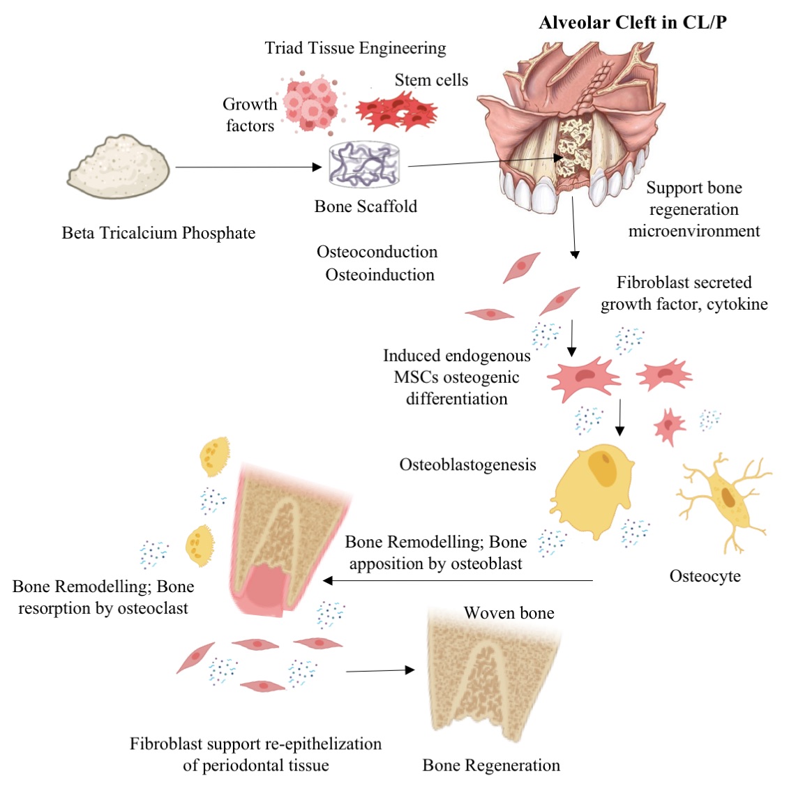 β-Tricalcium Phosphate as Alveolar Bone Grafting in Cleft Lip/Palate: A ...