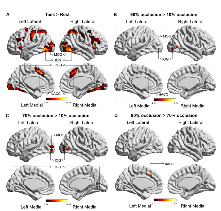 Brain Functional Representation of Highly Occluded Object Recognition[v1] | Preprints.org