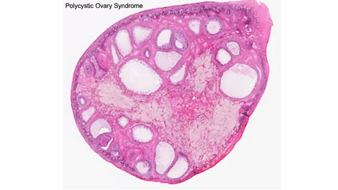 Phenotypic Characterization of Patients with Polycystic Ovary Syndrome ...