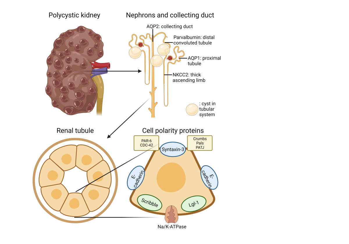 The Cyst Epithelium in Polycystic Kidney Disease Patients Displays ...