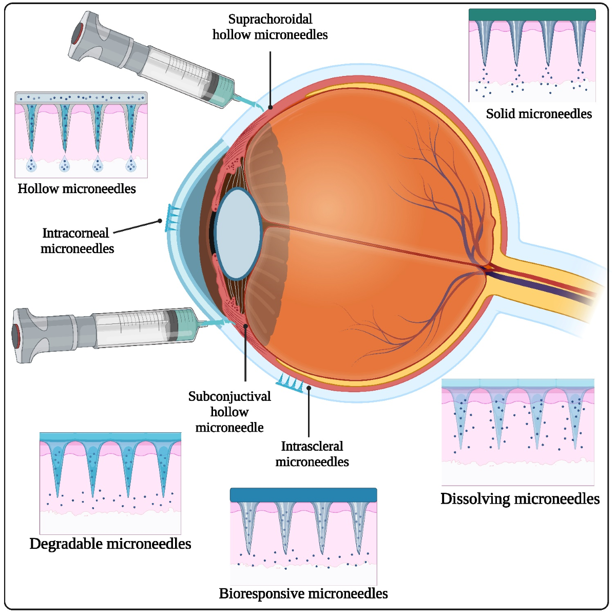 Revolutionizing Eye Care: Exploring the Potential of Microneedle Drug ...