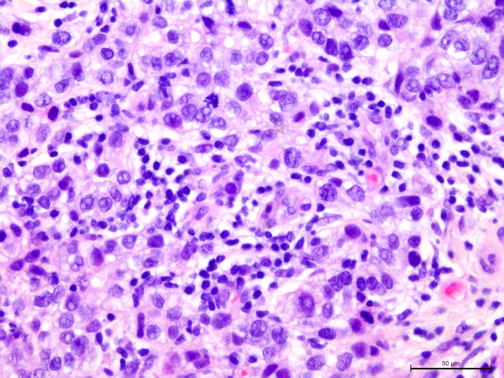 The role of androgen receptor expression and T-lymphocytes infiltration ...