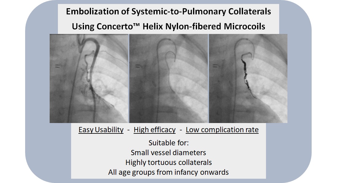 Transcatheter Embolization of Systemic-to-Pulmonary Collaterals – A New ...